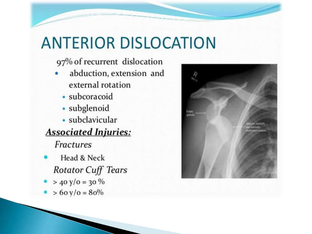 Shoulder instability- anatomy mechanism & treatment | PPT