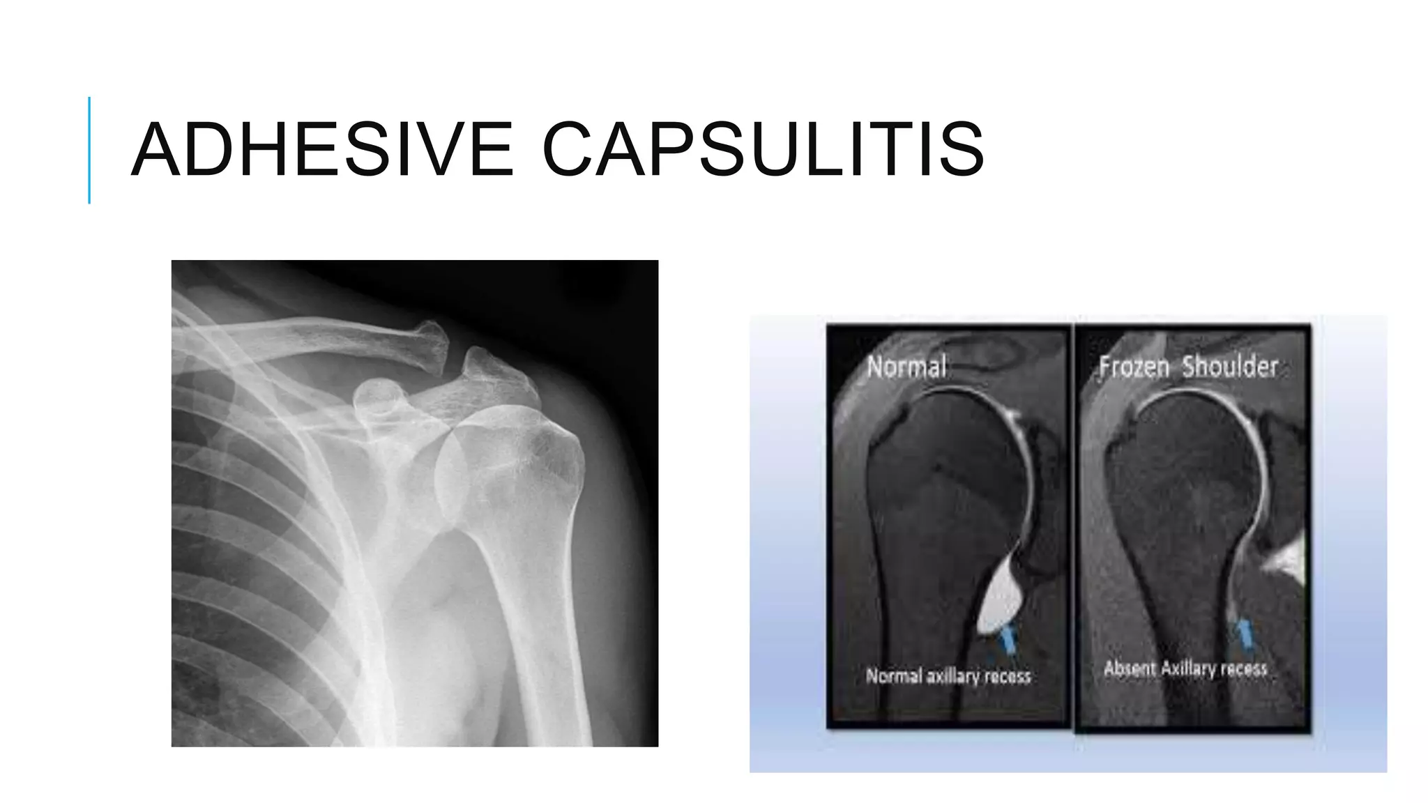 Adhesive Capsulitis | PPTX | Death, Injury, or Military Conflict ...