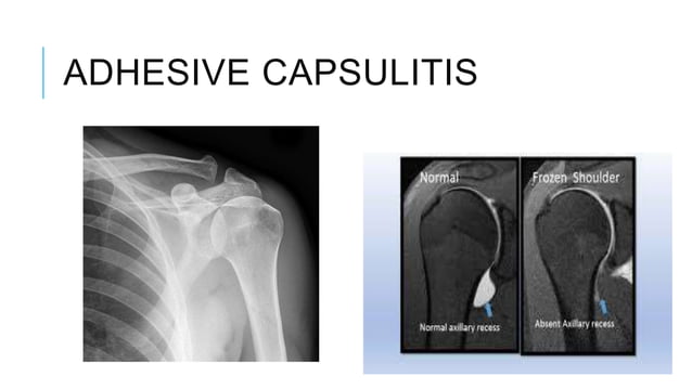 Adhesive Capsulitis | PPTX | Death, Injury, or Military Conflict ...