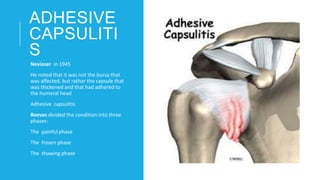 Adhesive Capsulitis | PPTX