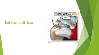 Anatomy And Injury around Shoulder Joint, Orthopaedics | PPTX