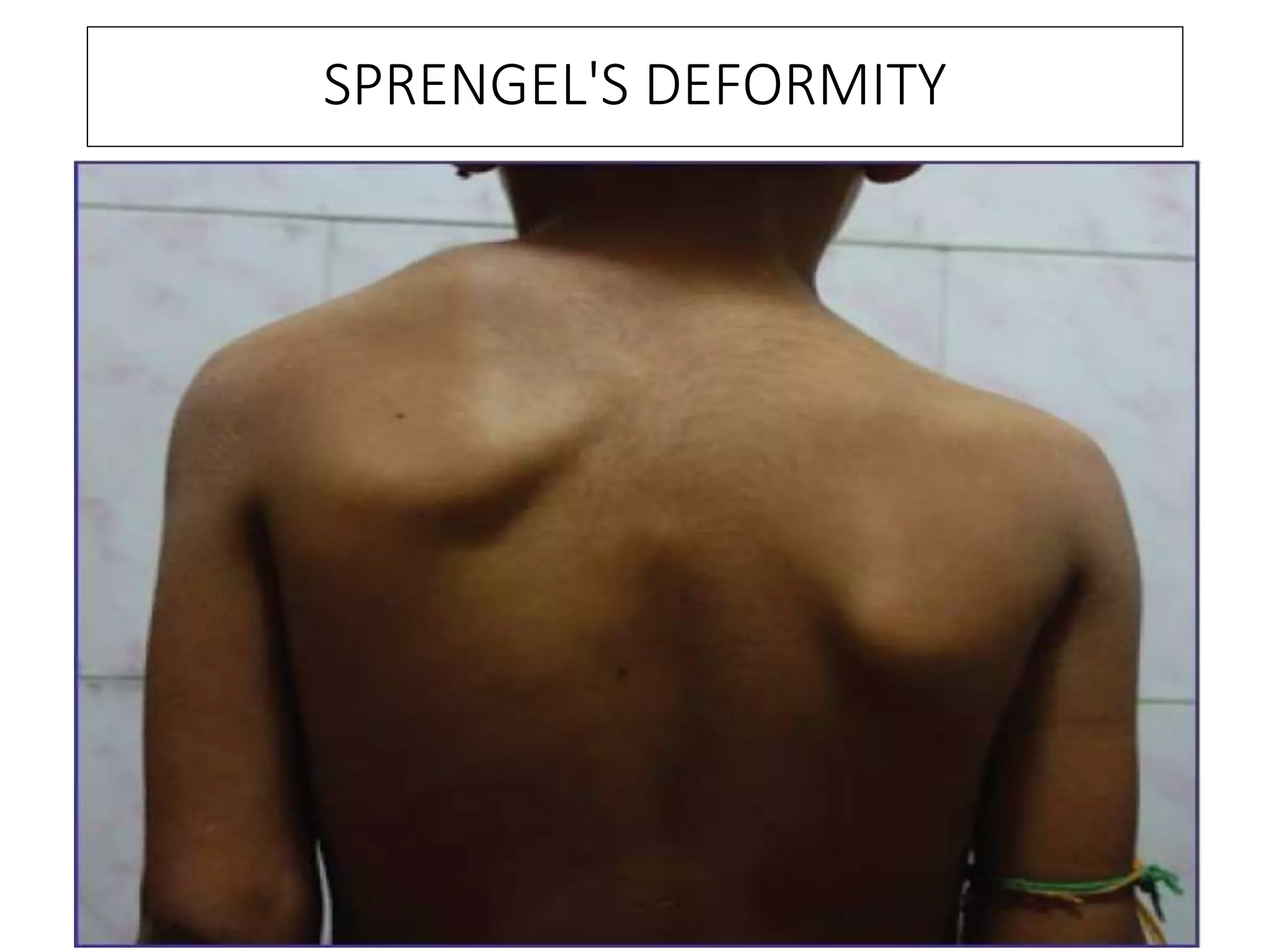 SHOULDER JOINT ASSESSMENT AND ADHESIVE CAPSULITIS PPT BY KISHWER JAHAN ...