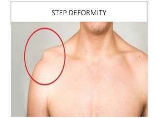 SHOULDER JOINT ASSESSMENT AND ADHESIVE CAPSULITIS PPT BY KISHWER JAHAN ...