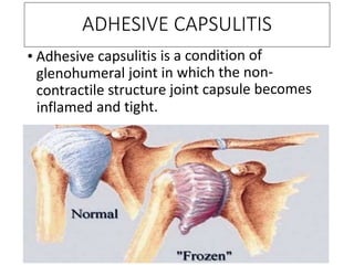 SHOULDER JOINT ASSESSMENT AND ADHESIVE CAPSULITIS PPT BY KISHWER JAHAN ...