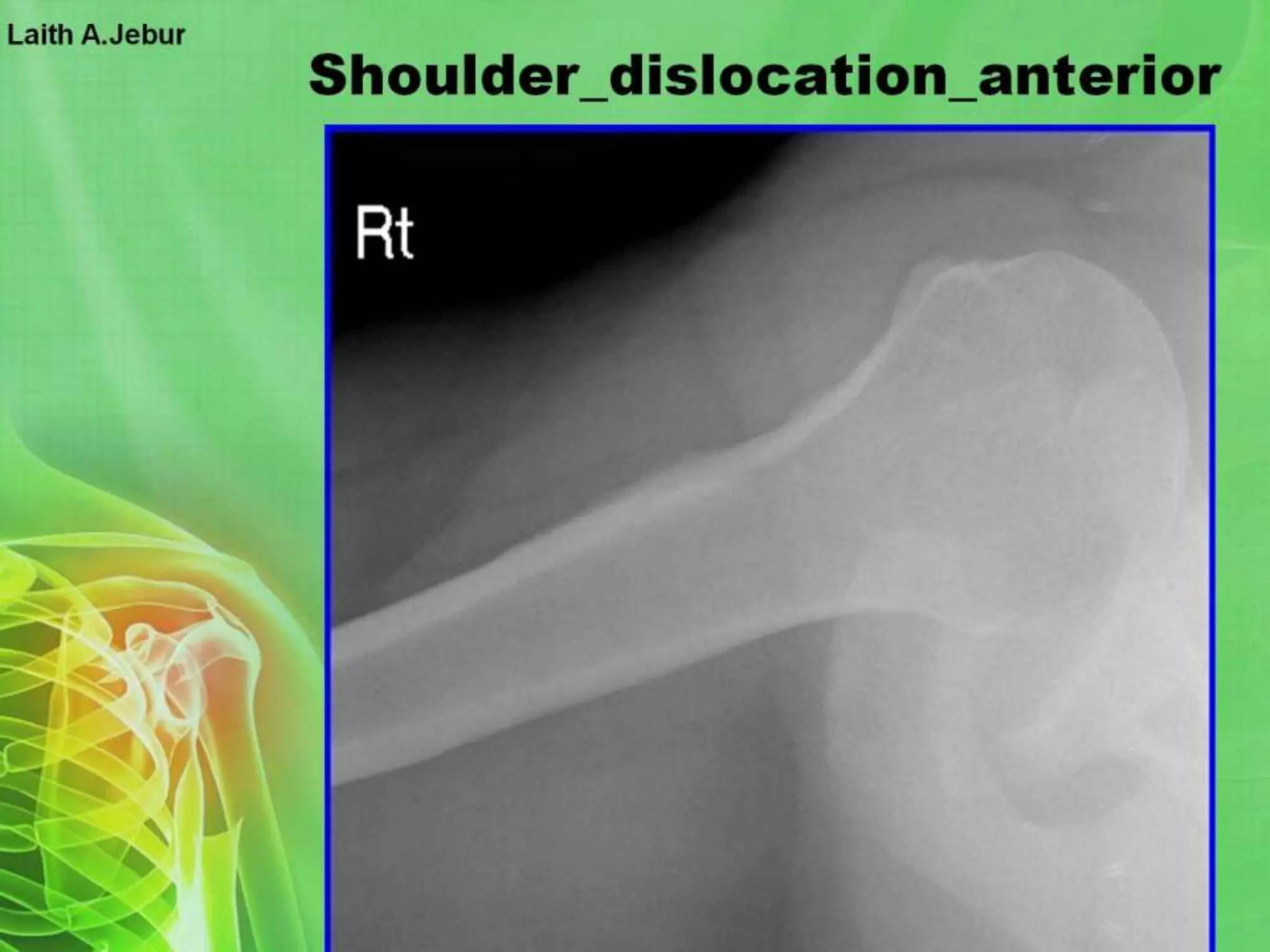 X Rays of Shoulder joint diseases | PPSX | Medical Health