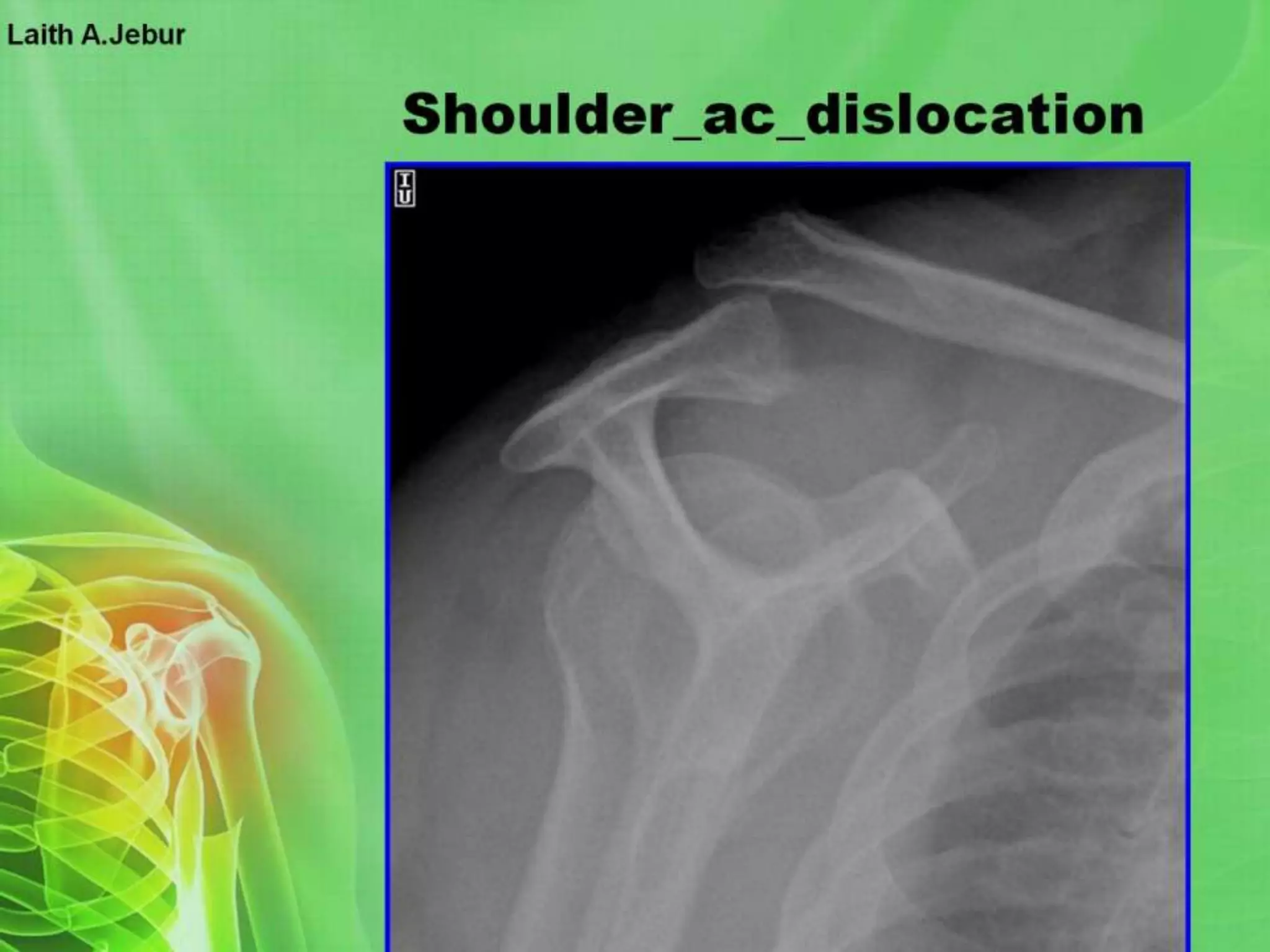 X Rays of Shoulder joint diseases | PPSX | Medical Health