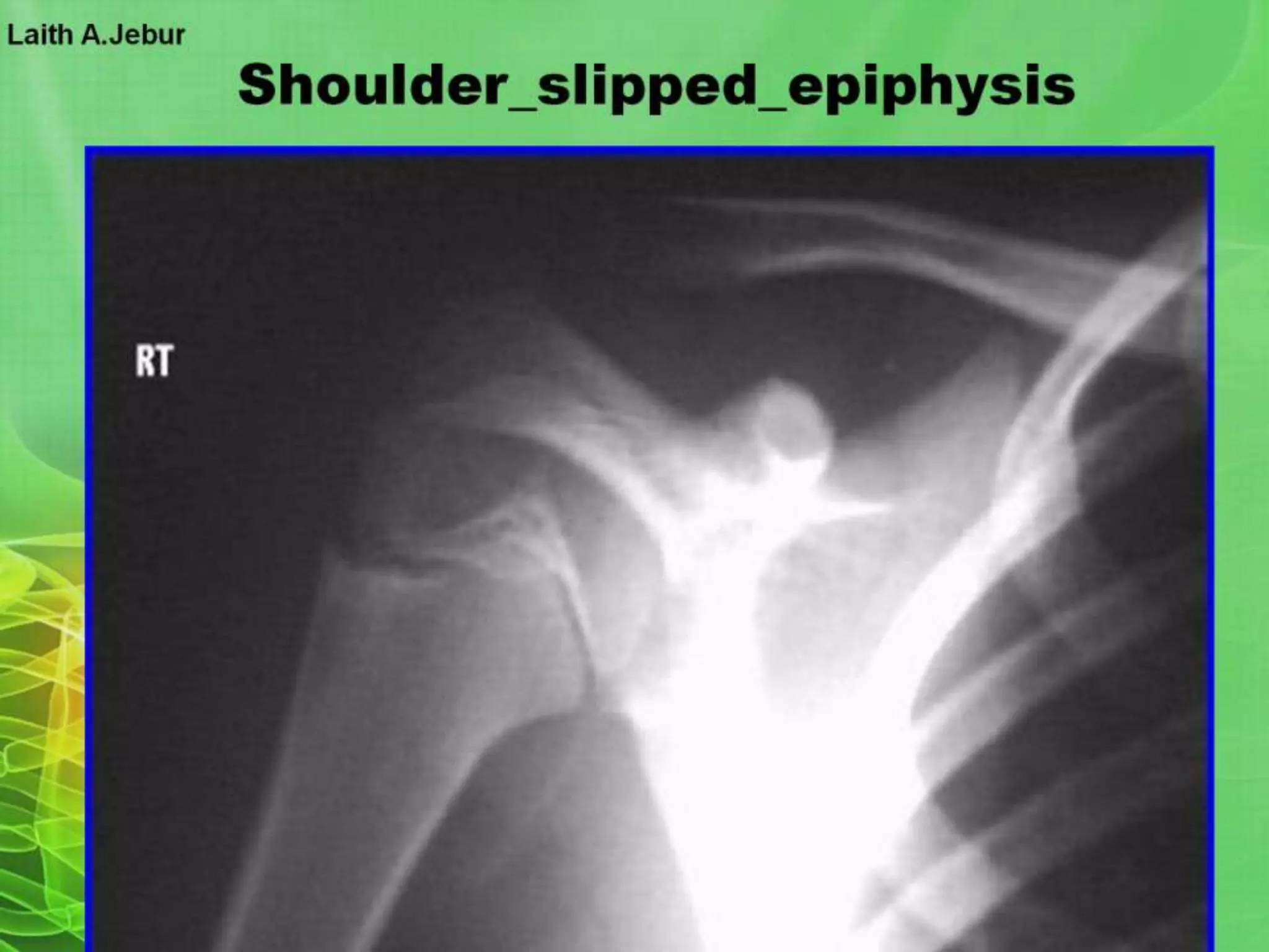 X Rays of Shoulder joint diseases | PPSX | Medical Health