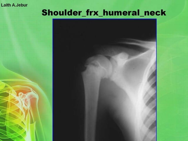 X Rays of Shoulder joint diseases | PPSX | Medical Health