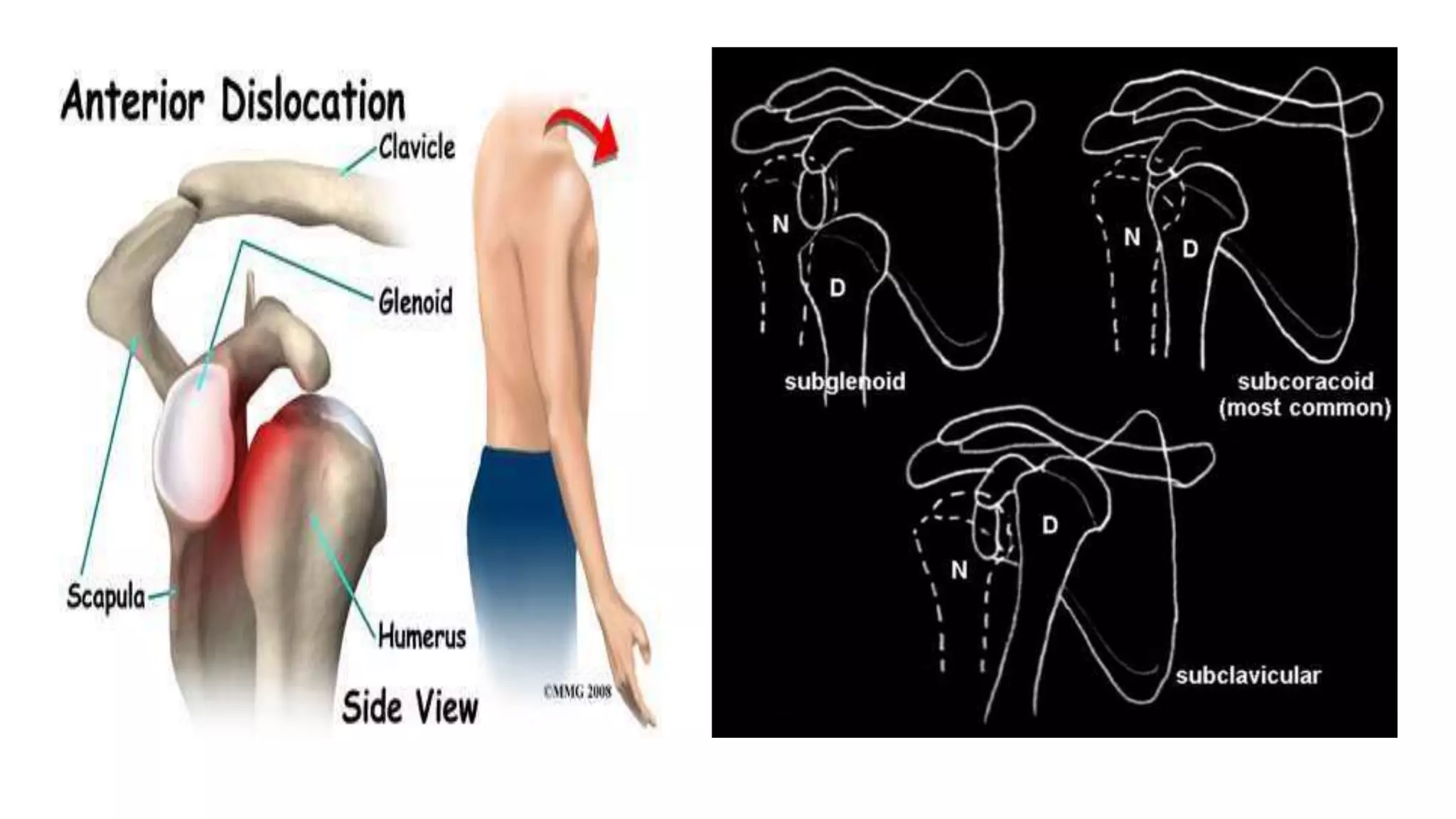 Shoulder joint instability | PPT