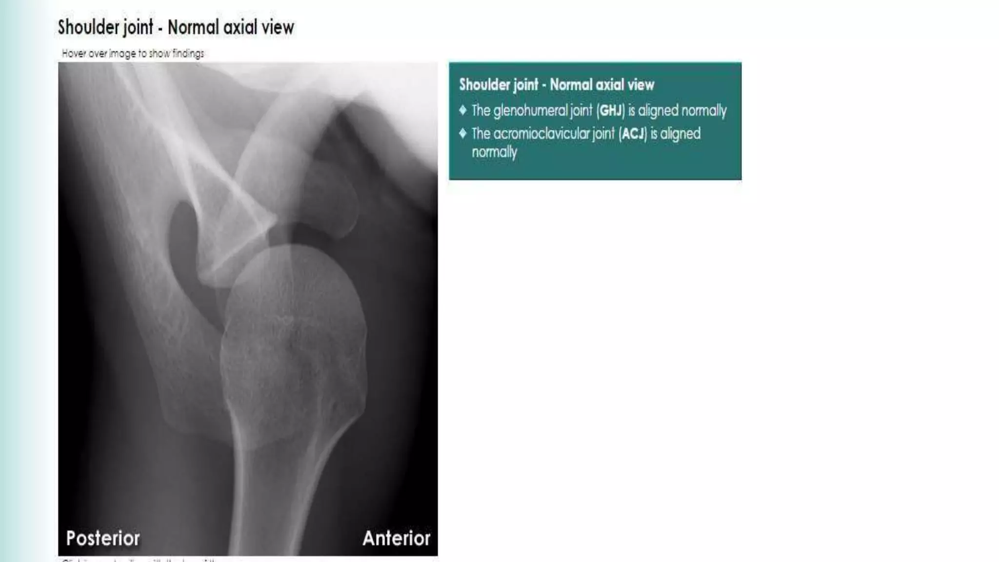 Shoulder joint instability | PPT