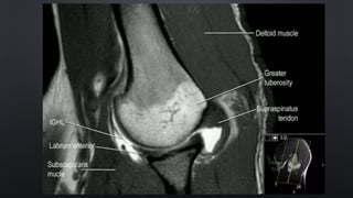 SHOULDER JOINT LIGAMENTS & CAPSULE-RADIOLOGY.pptx