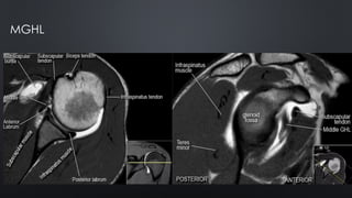 SHOULDER JOINT LIGAMENTS & CAPSULE-RADIOLOGY.pptx