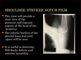 Stryker View Shoulder