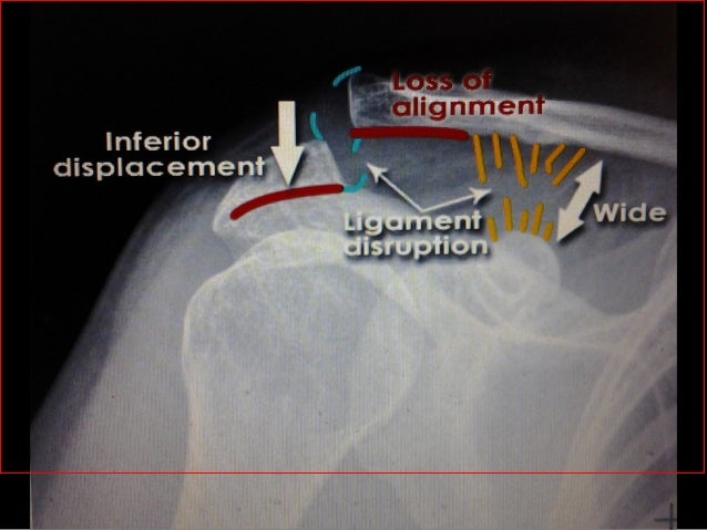 Shoulder joint xray & usg by Dr Soumitra Halder