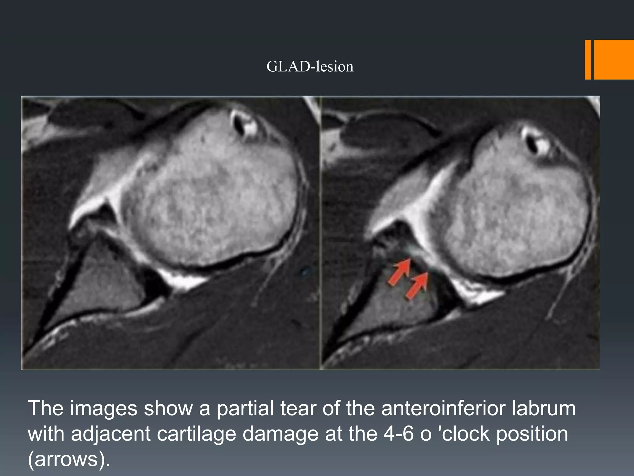 Shoulder labral tears MRI