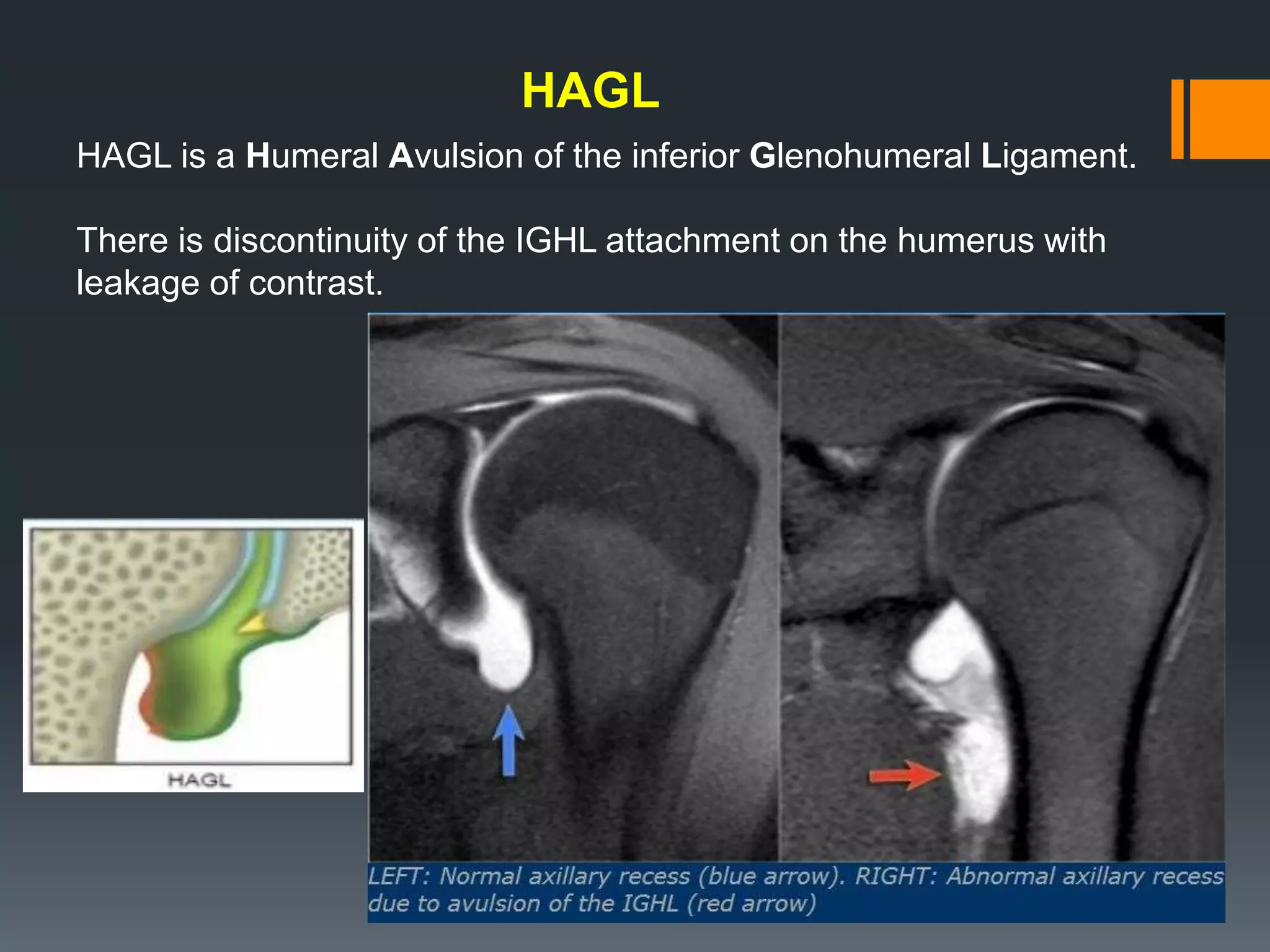 Shoulder labral tears MRI