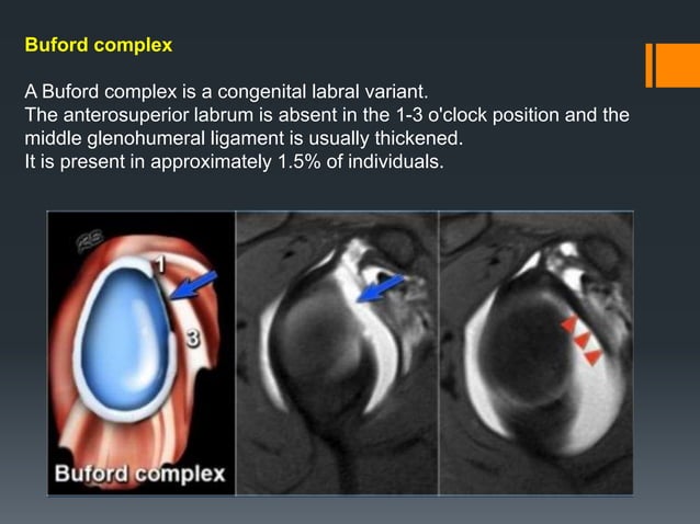 Shoulder labral tears MRI | PPTX
