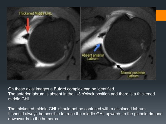 Shoulder labral tears MRI | PPTX