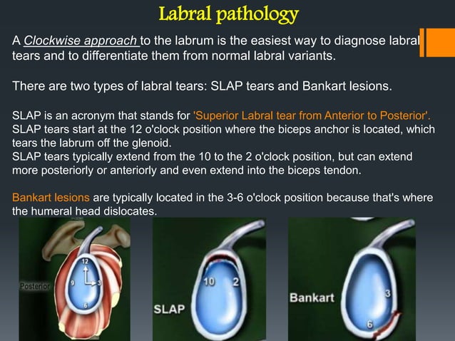 Shoulder labral tears MRI | PPTX