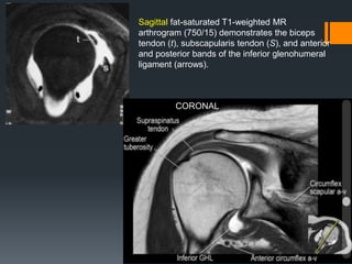 Labrum Tear Mri