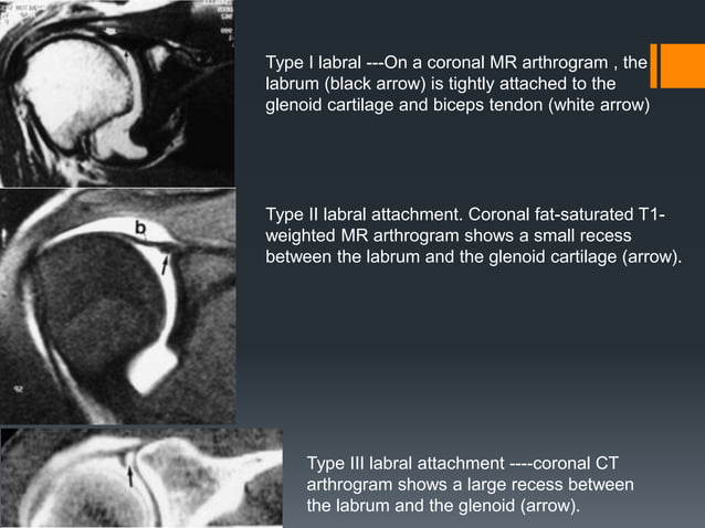 Shoulder labral tears MRI