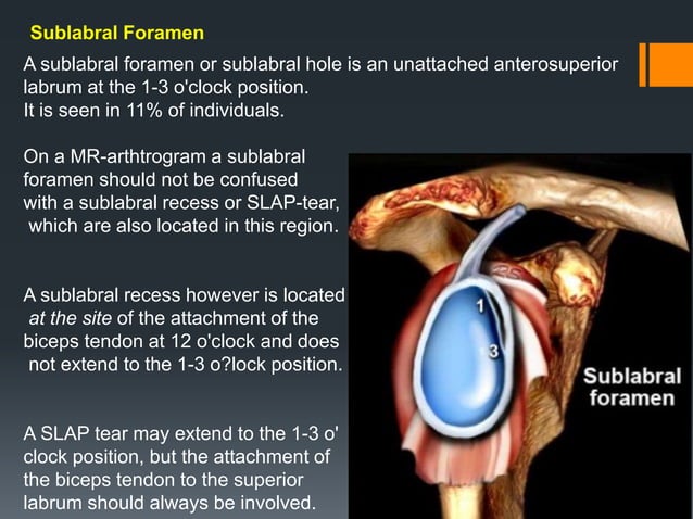 Shoulder Labral Tears Mri