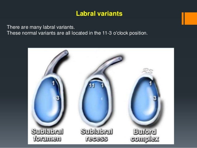 Shoulder labral tears MRI