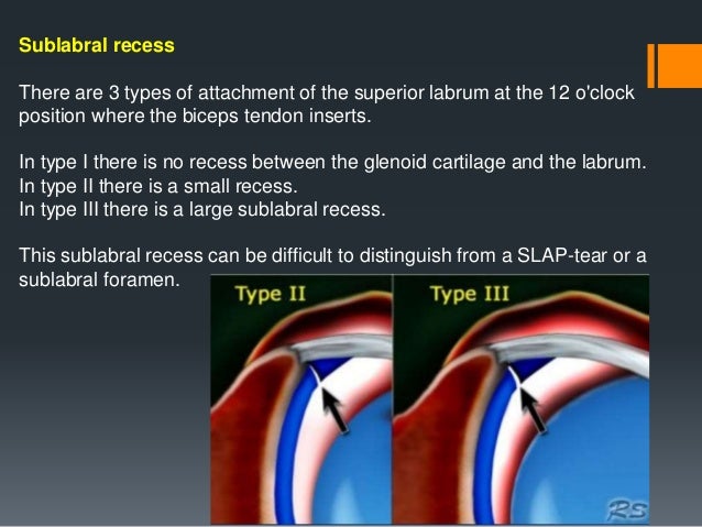 Shoulder labral tears MRI