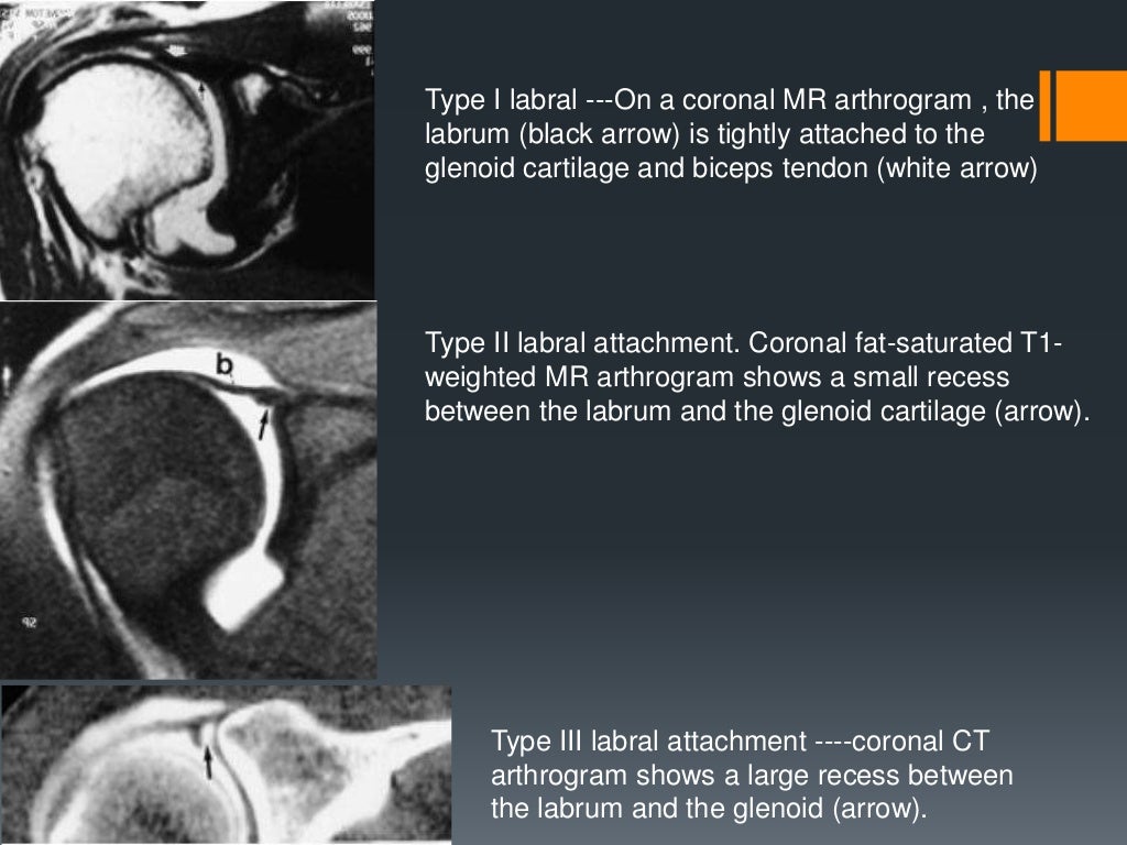 Shoulder labral tears MRI