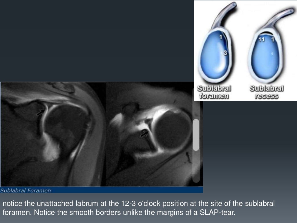 Shoulder Labral Tears Mri