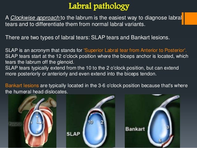 Shoulder labral tears MRI