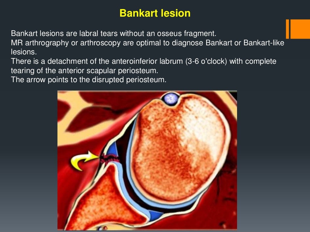 Shoulder labral tears MRI