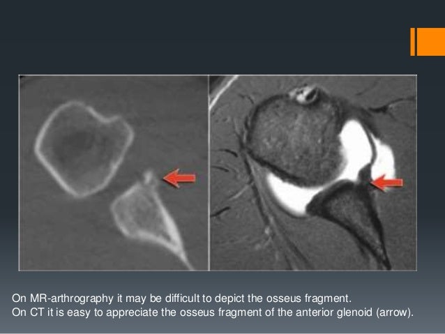 Shoulder Labral Tears Mri