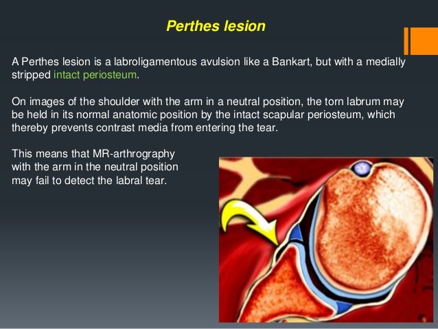 Shoulder labral tears MRI