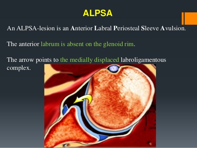 Shoulder labral tears MRI
