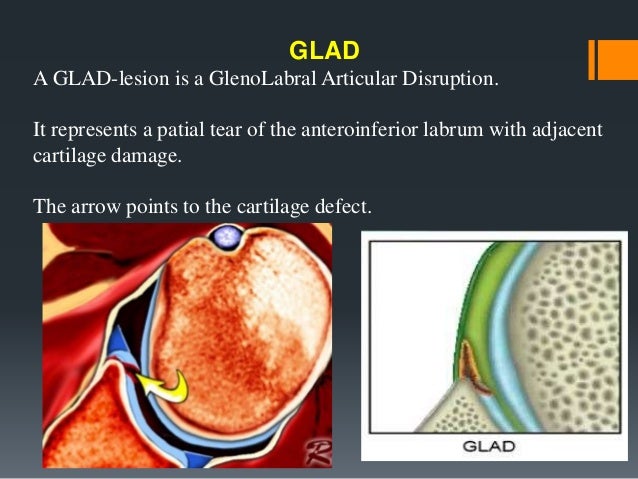 Shoulder labral tears MRI