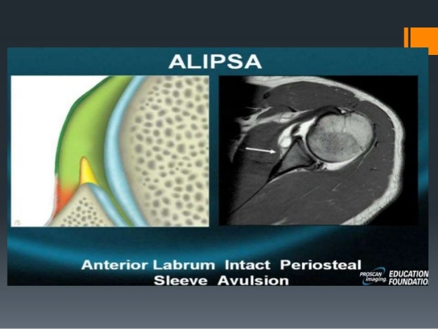 Shoulder Labral Tears Mri