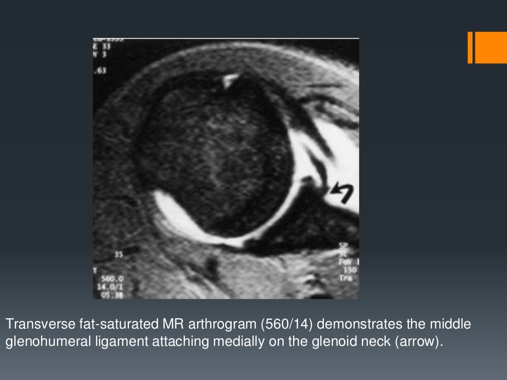 Shoulder Labral Tears Mri