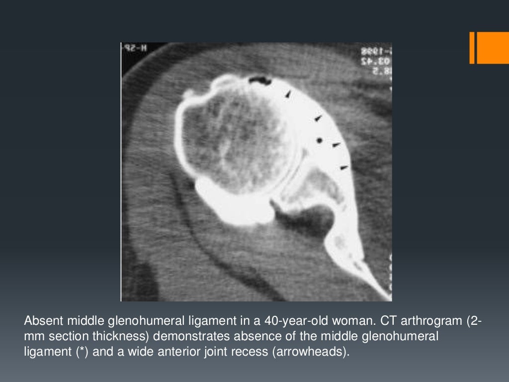 Shoulder Labral Tears Mri