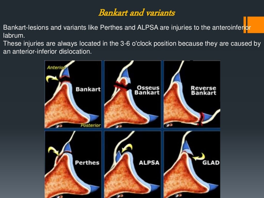Shoulder labral tears MRI