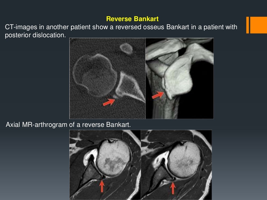 Shoulder labral tears MRI