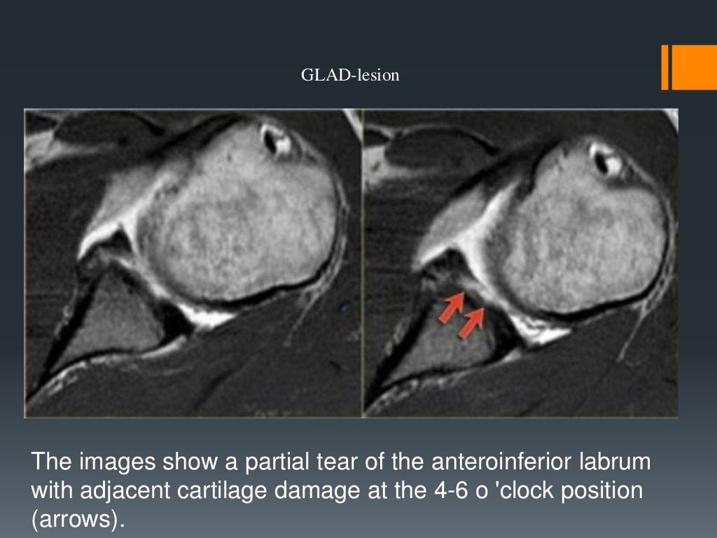 shoulder-labral-tears-mri