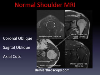 Shoulder Mri Scan in Delhi by Dr Shekhar Shrivastav | PDF