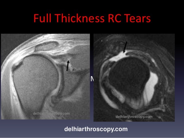 Shoulder Mri Scan in Delhi by Dr Shekhar Shrivastav