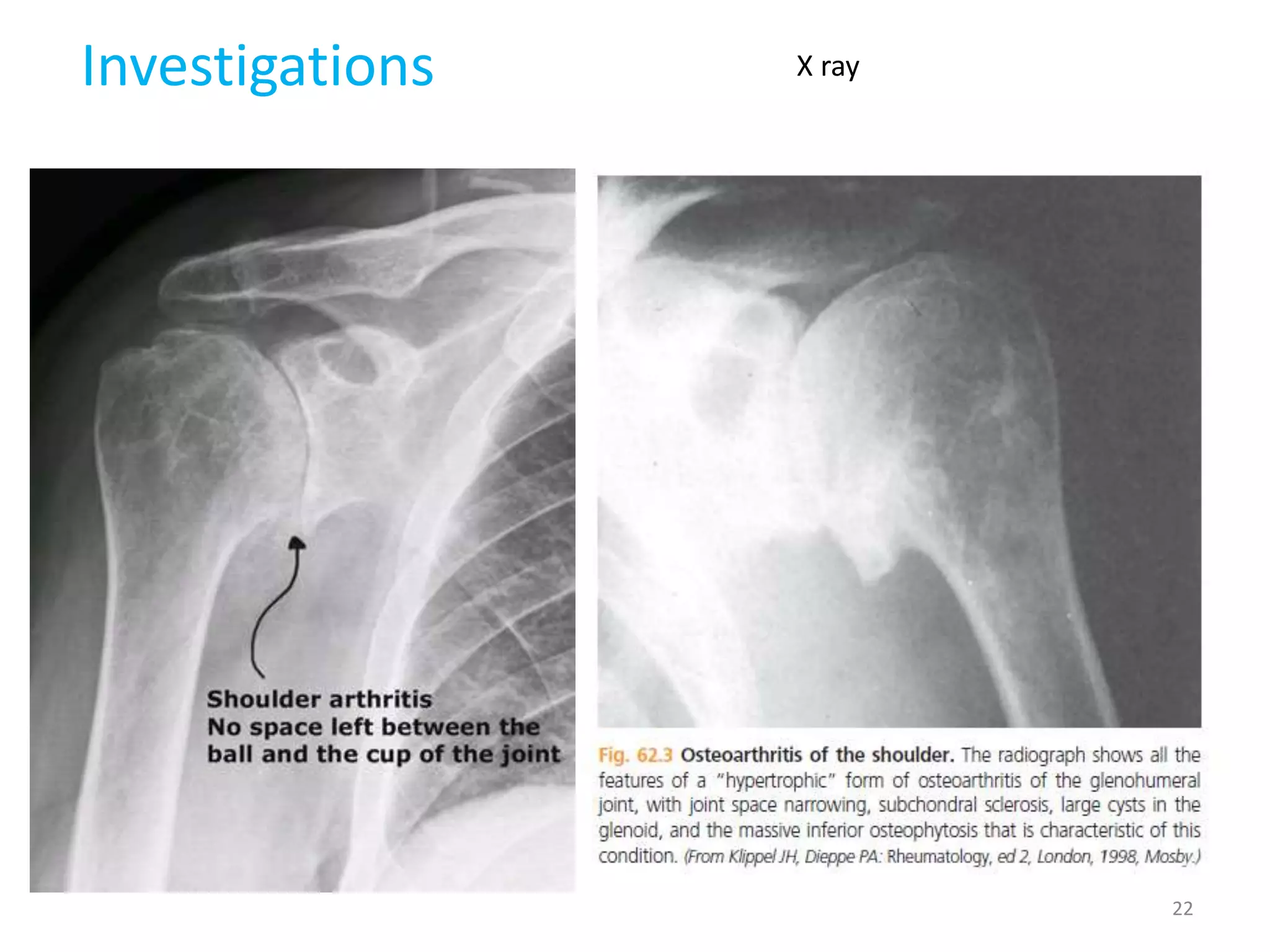 SHOULDER PAIN Diff. Diagnosis RB.pptx