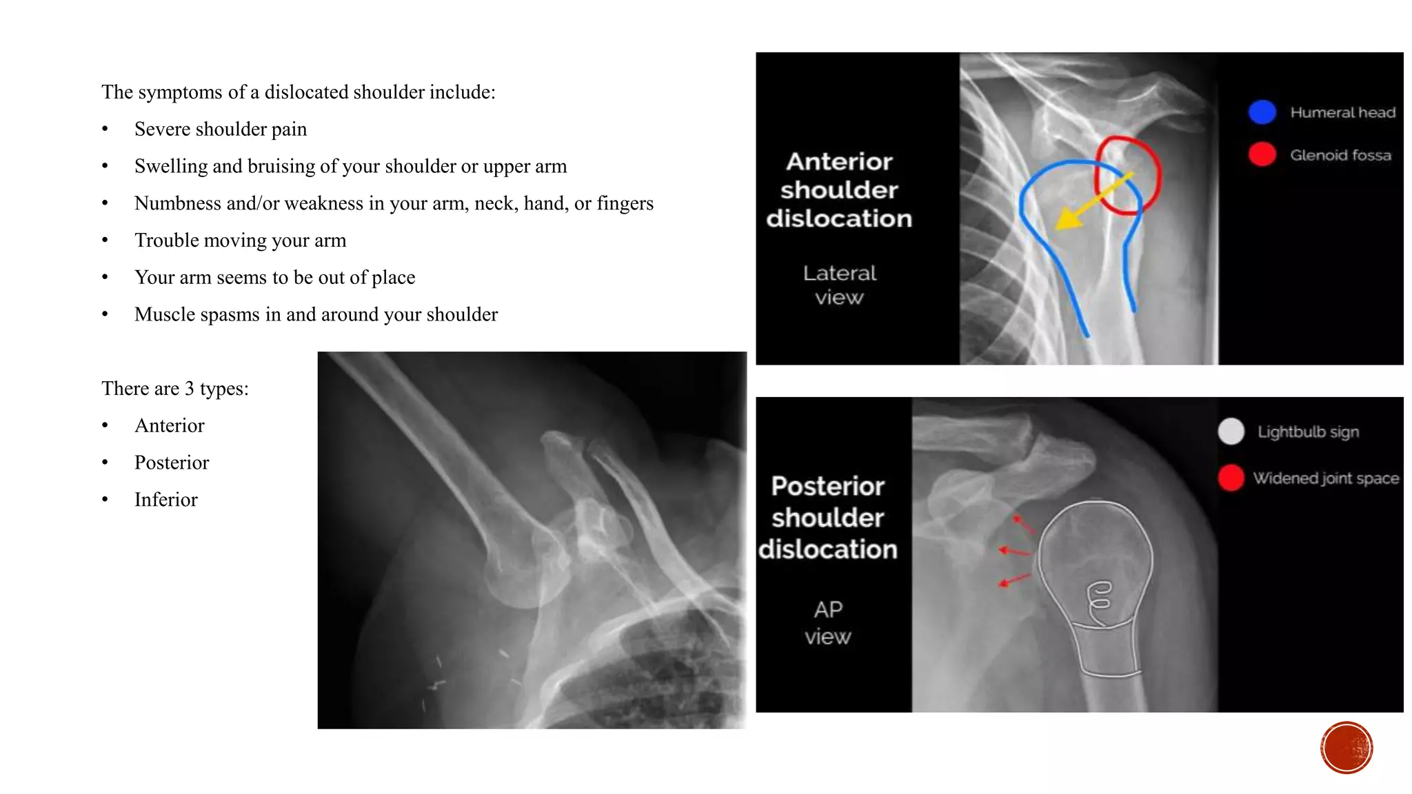 shoulder patho.pptx