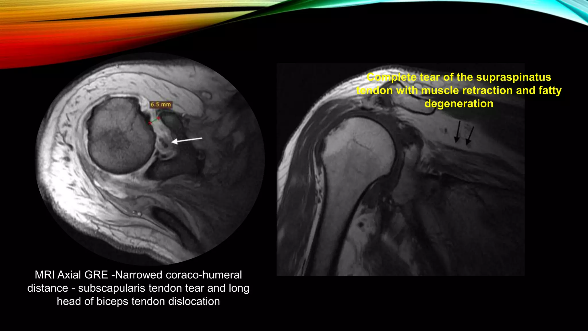 Shoulder pathologies | PPTX