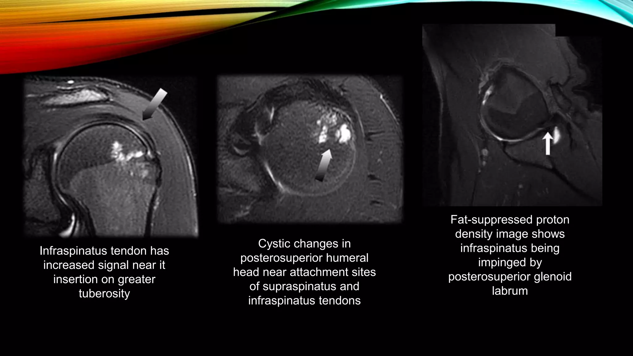 Shoulder pathologies | PPTX