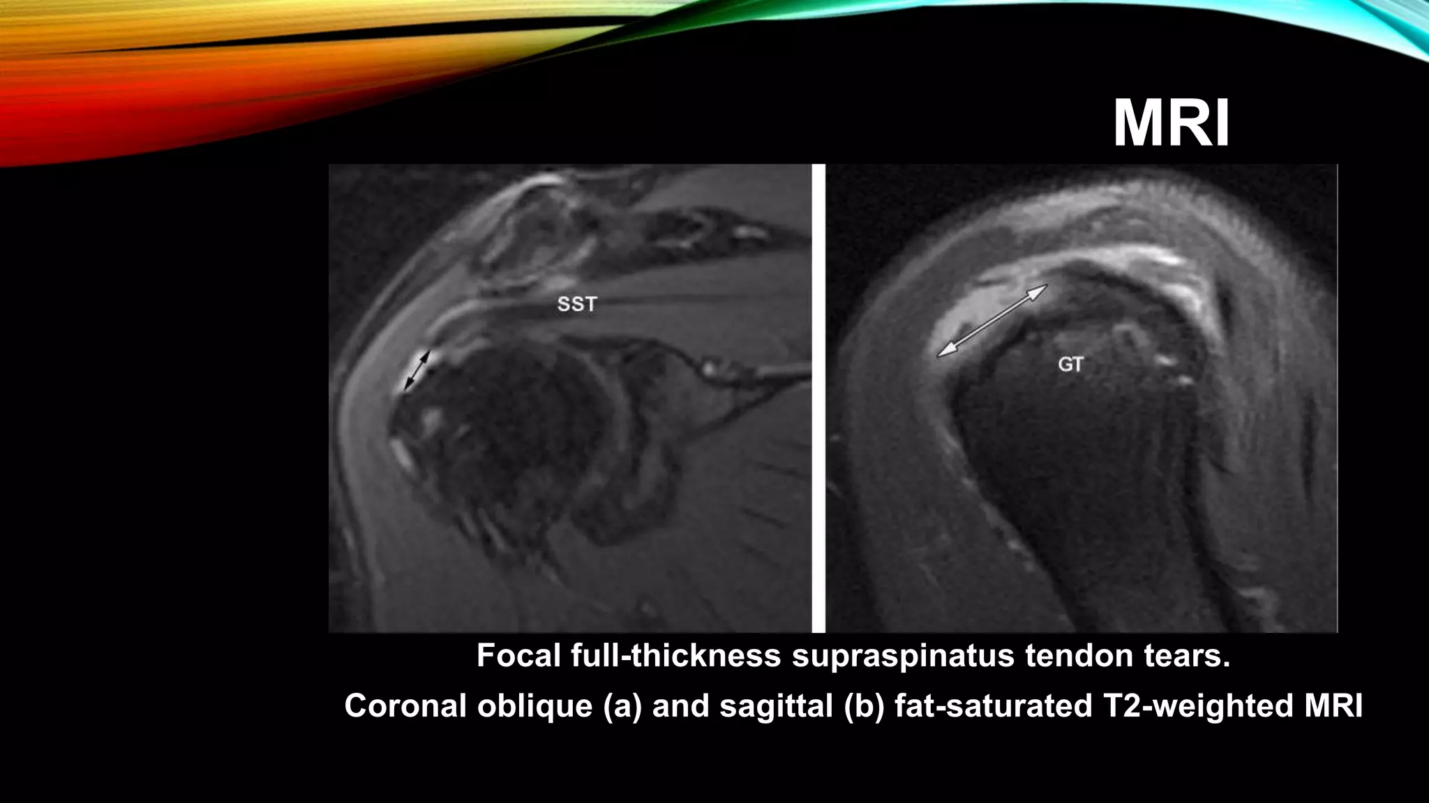 Shoulder pathologies | PPTX