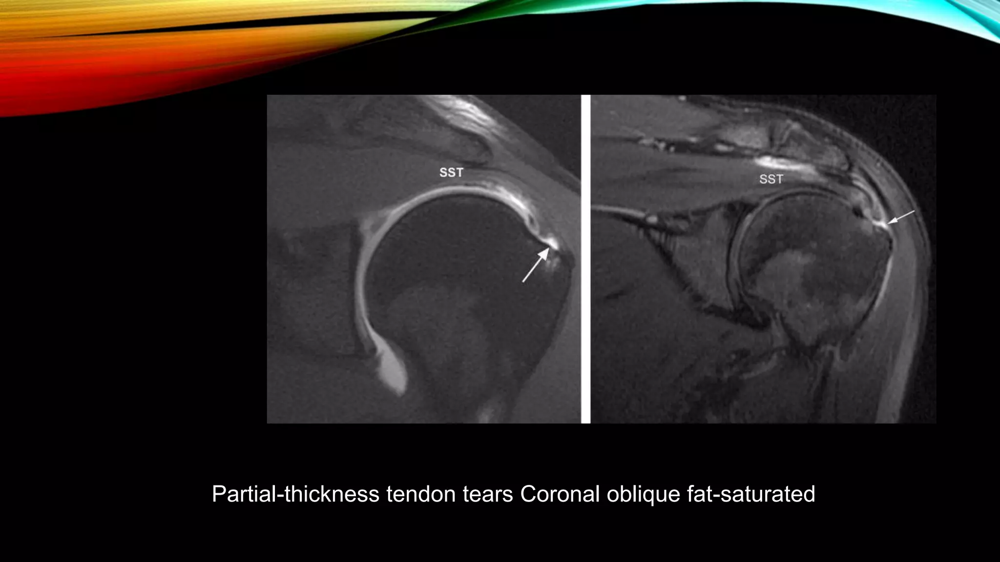 Shoulder pathologies | PPTX